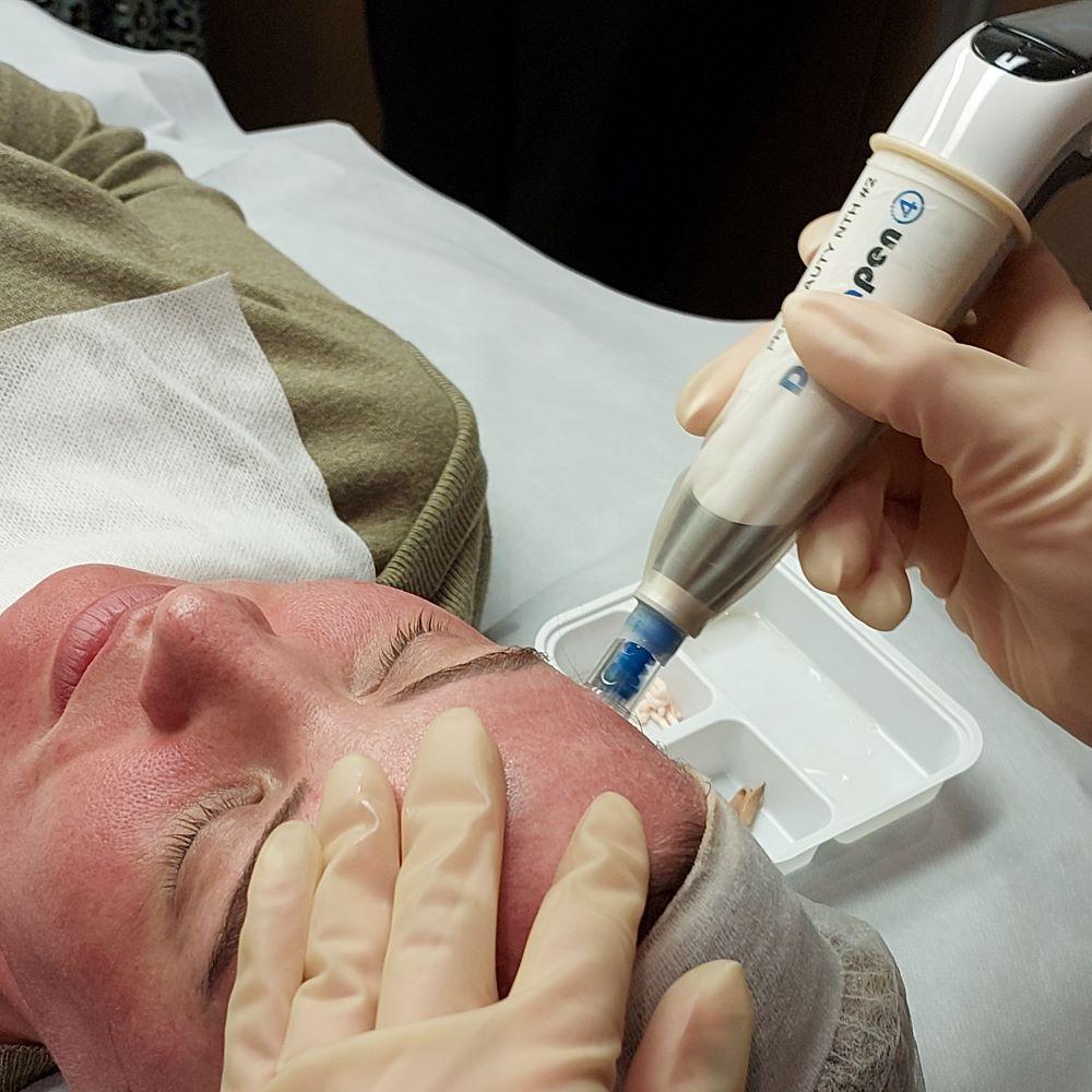 Features | Introducing dermal needling